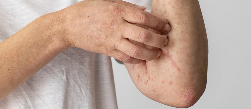Psoríase: O que é? Causas e tratamentos | CID Grupo